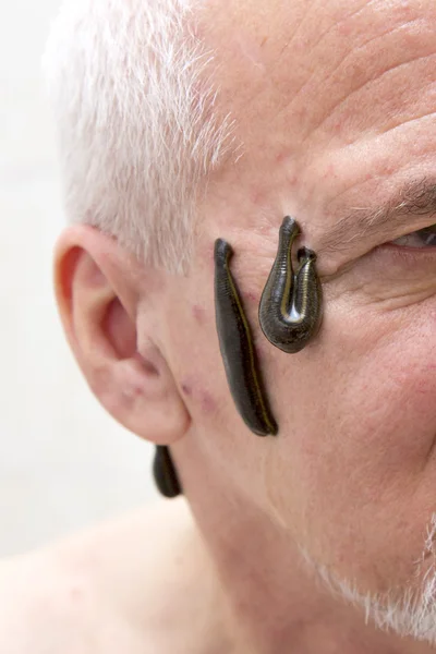 Leech on human skin — Stock Photo © sydeen #6171469
