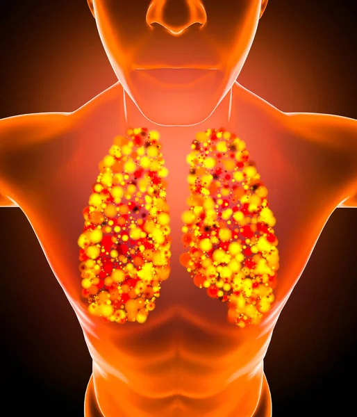 Human Anatomy Problems Respiratory System Severely Damaged Lungs ...
