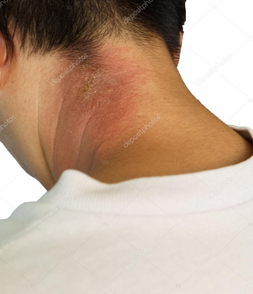 Rash on neck isolated on white background Stock Photo by ©psisaa 72983627