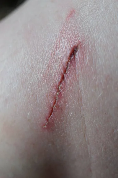 Bite wounds Stock Photos, Royalty Free Bite wounds Images | Depositphotos