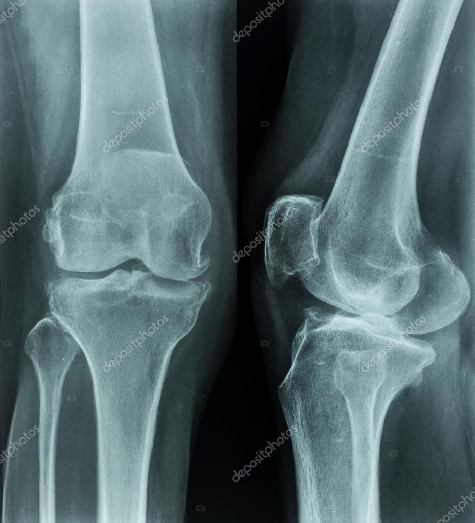 X Ray Leg