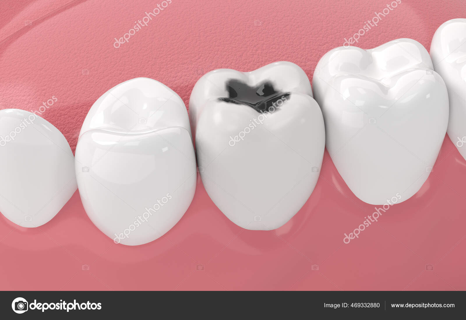 Tooth Decay Unhealthy Teeth Rendering Computer Digital Drawing Stock ...
