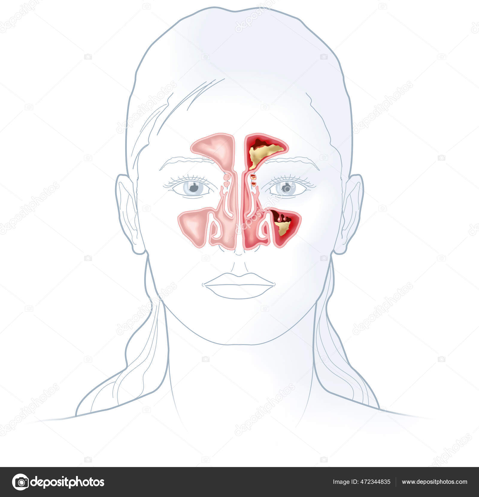 Seios Saudáveis Sinusite Com Revestimento Inflamado Abertura Sinusal ...