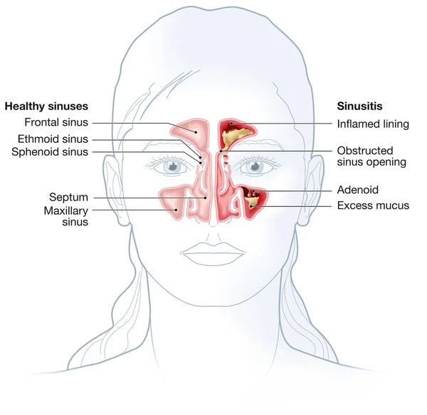 Seios Saudáveis Sinusite Com Revestimento Inflamado Abertura Sinusal ...