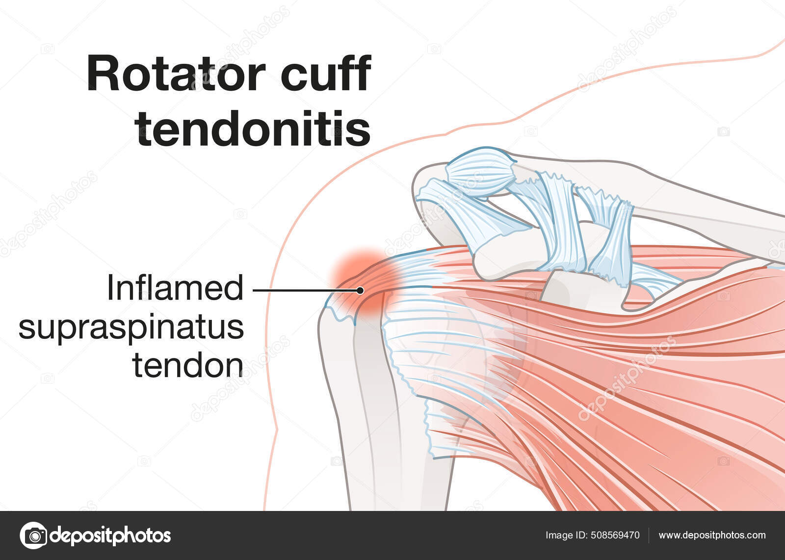 Shoulder Anatomy Rotator Cuff Tendonitis Inflamed, 49% OFF Shoulder Anatomy Rotator Cuff Tendonitis Inflamed, 49% OFF