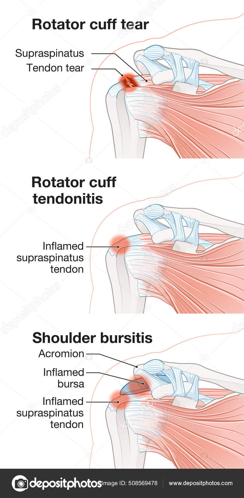 Shoulder Pain Rotator Cuff Tear Rotator Cuff Tendonitis Shoulder ...