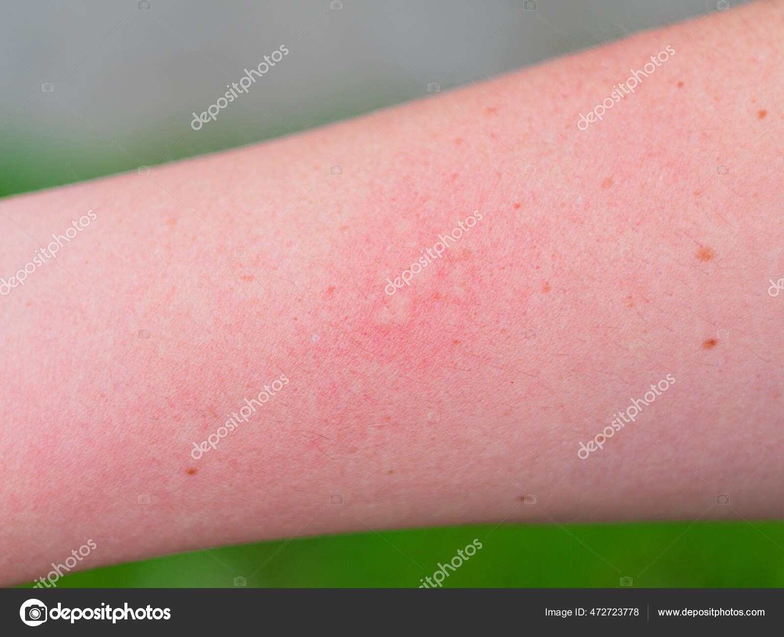 Hand Mit Dermatitis Rot Juckende Geschwollene Haut Nach Berührung ...