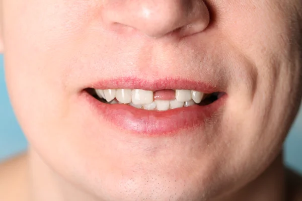Homem sem dente Stock Photos, Royalty Free Homem sem dente Images ...