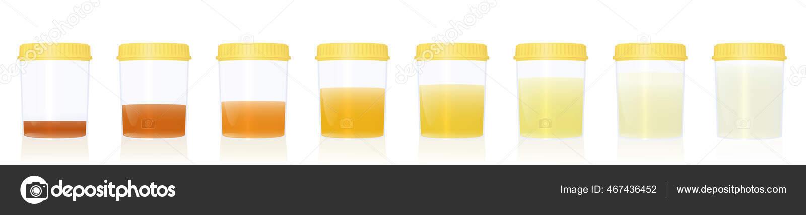 Urine Sample Colors