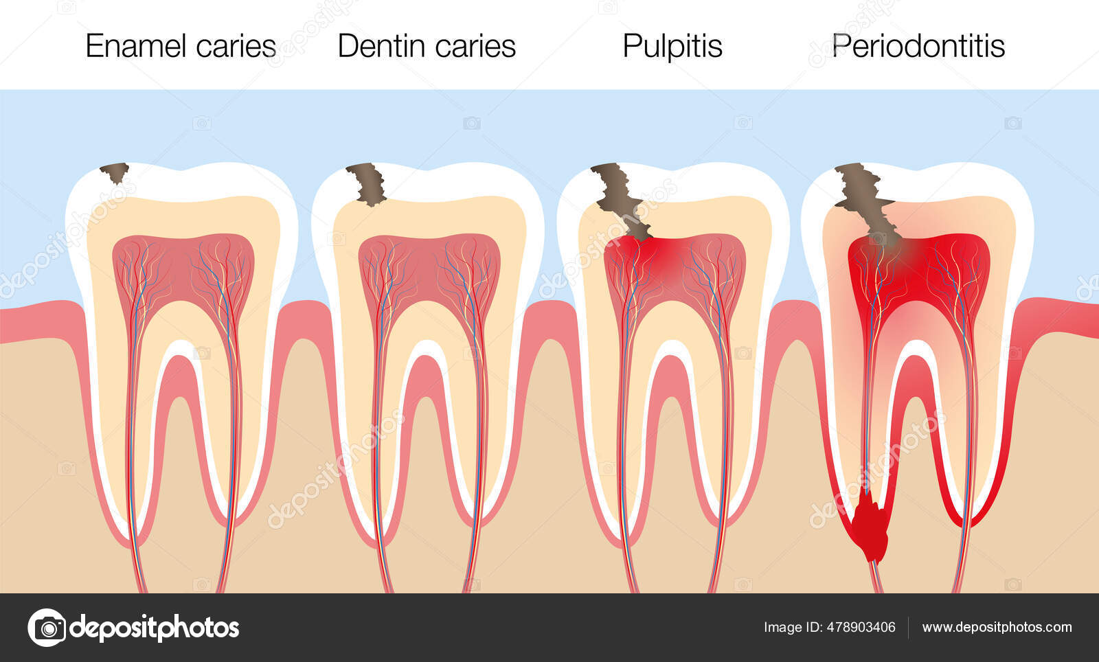 Gigi Dengan Tahap Karies Perkembangan Kerusakan Gigi Dengan Karies ...