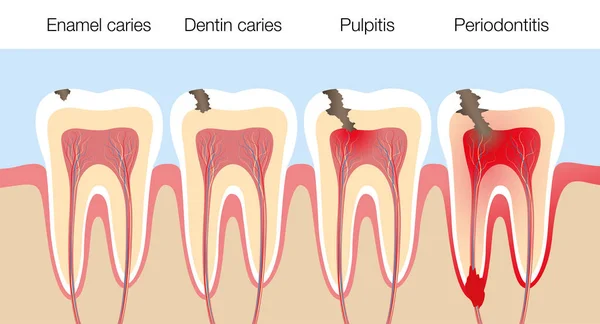 Periodontitis caries Stock fotók, Periodontitis caries Jogdíjmentes ...