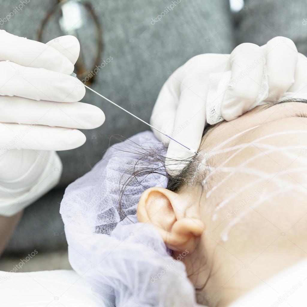 PDO Suture operation — Stock Photo © AppleEyesStudio #75082983