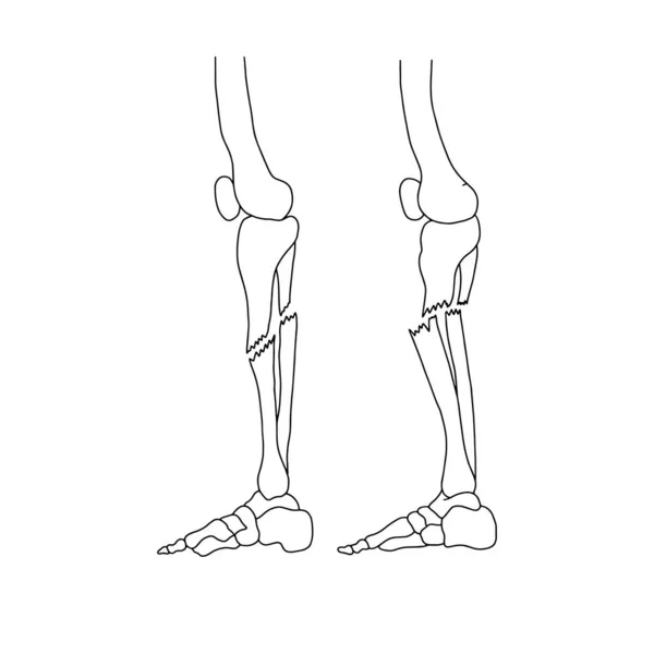 100,000 Lower leg anatomy Vector Images | Depositphotos