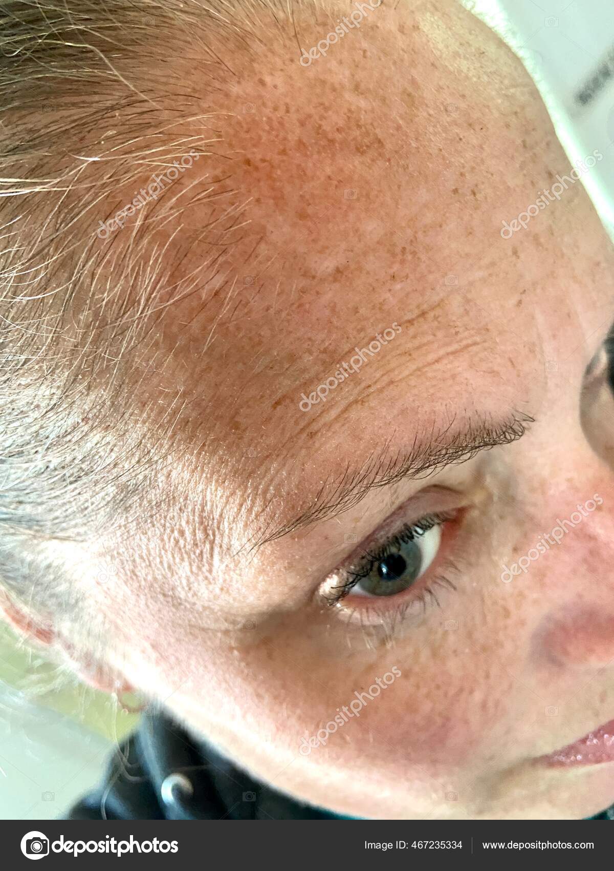 Addisons Disease Face