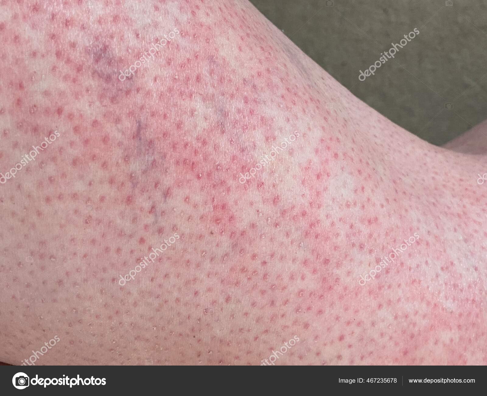 Heat Rash Knees