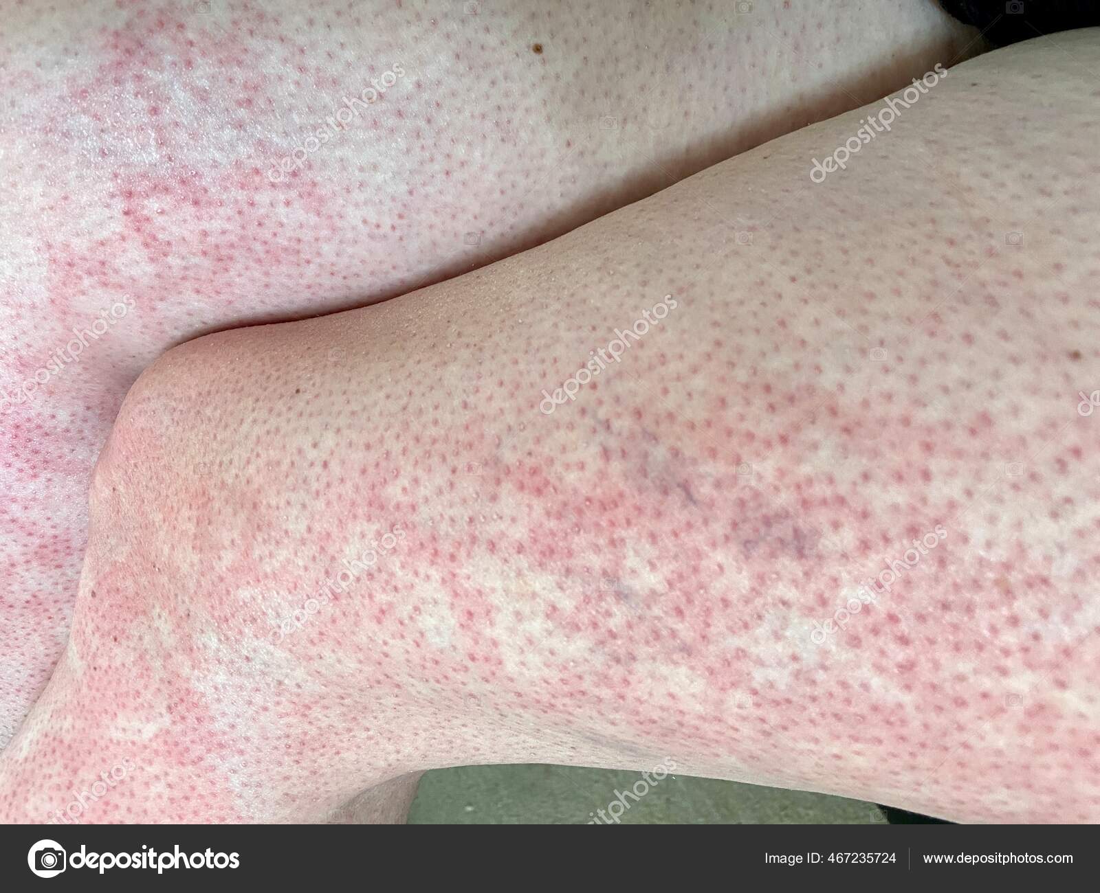 Heat Rash Hives Allergy Reaction Knee Close Reference Picture Blotchy ...