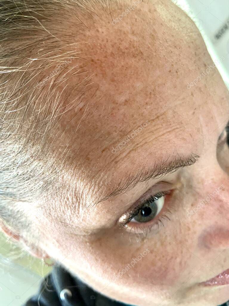 cara de una mujer con hiperpigmentación melasma de rara enfermedad de ...