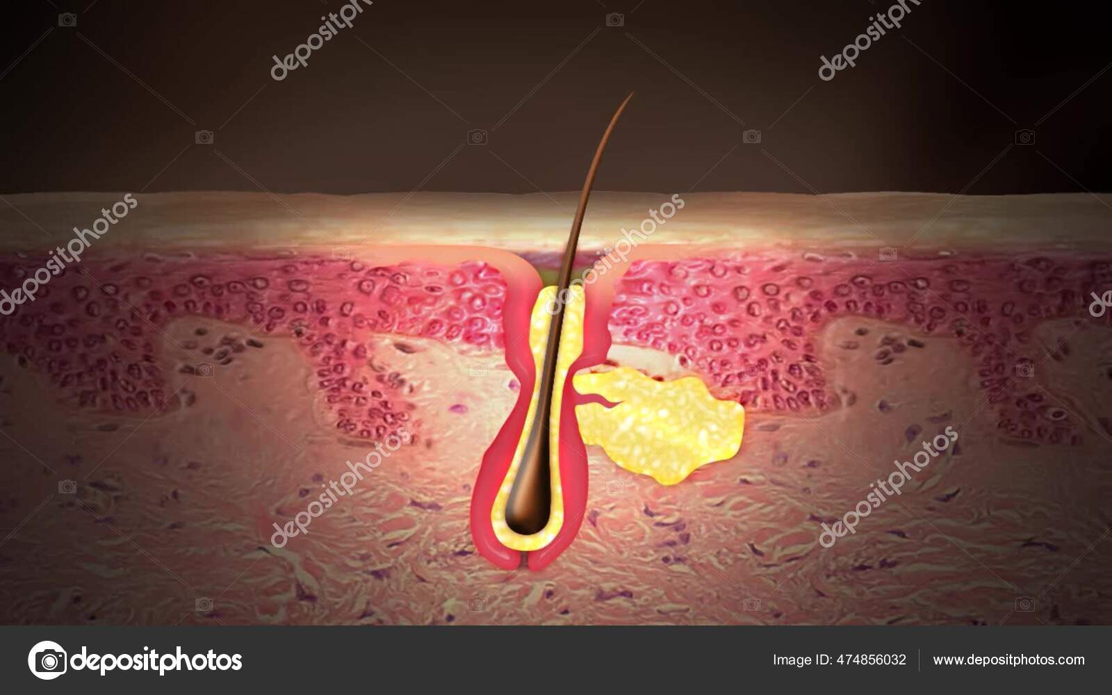 Acne Pimples Stages Development Graphic Animation — Stock Photo ...