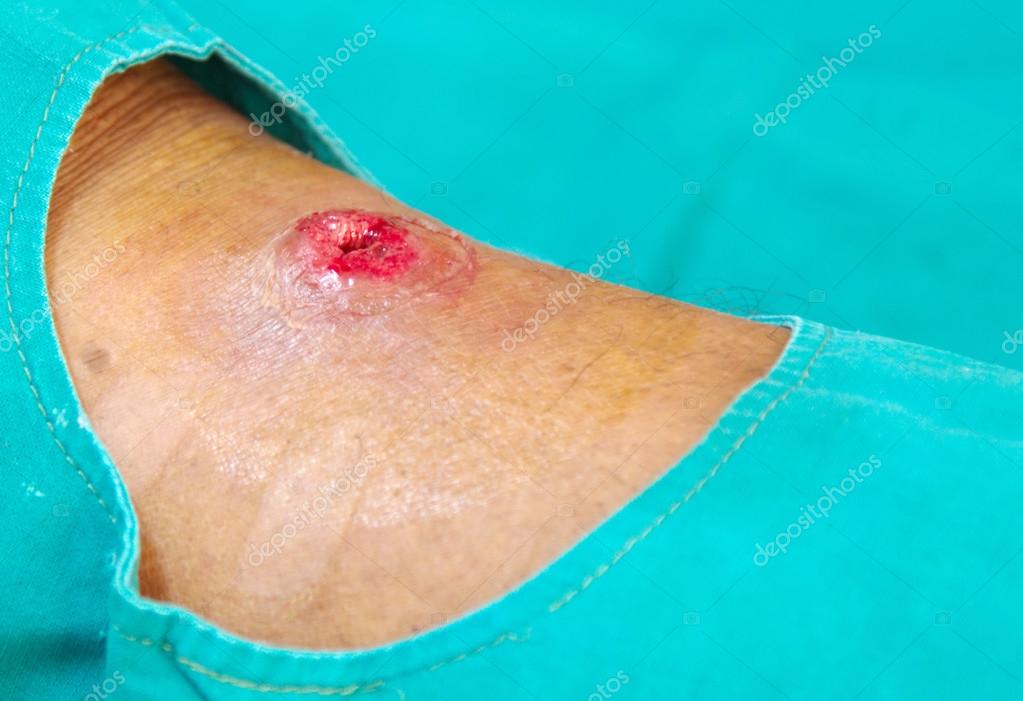 Abscess wound — Stock Photo © wellcom22 #65518089