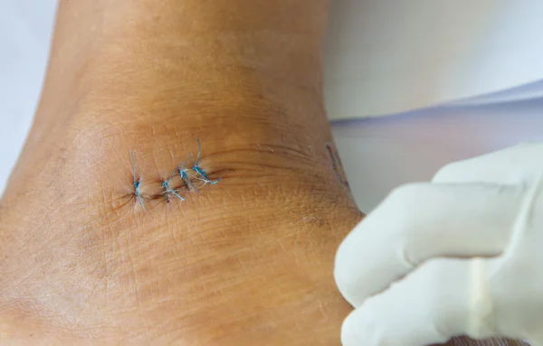 Surgical suture Stock Photos, Royalty Free Surgical suture Images ...