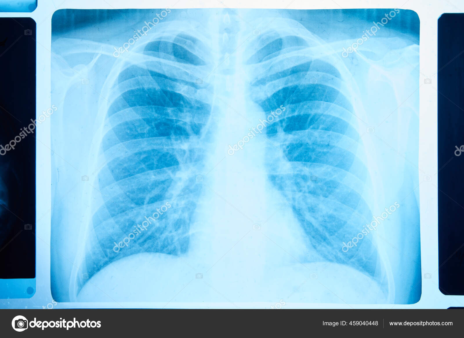 Image D'un Film Radiographique Vue Frontale Poitrine Humaine Prise Pour ...