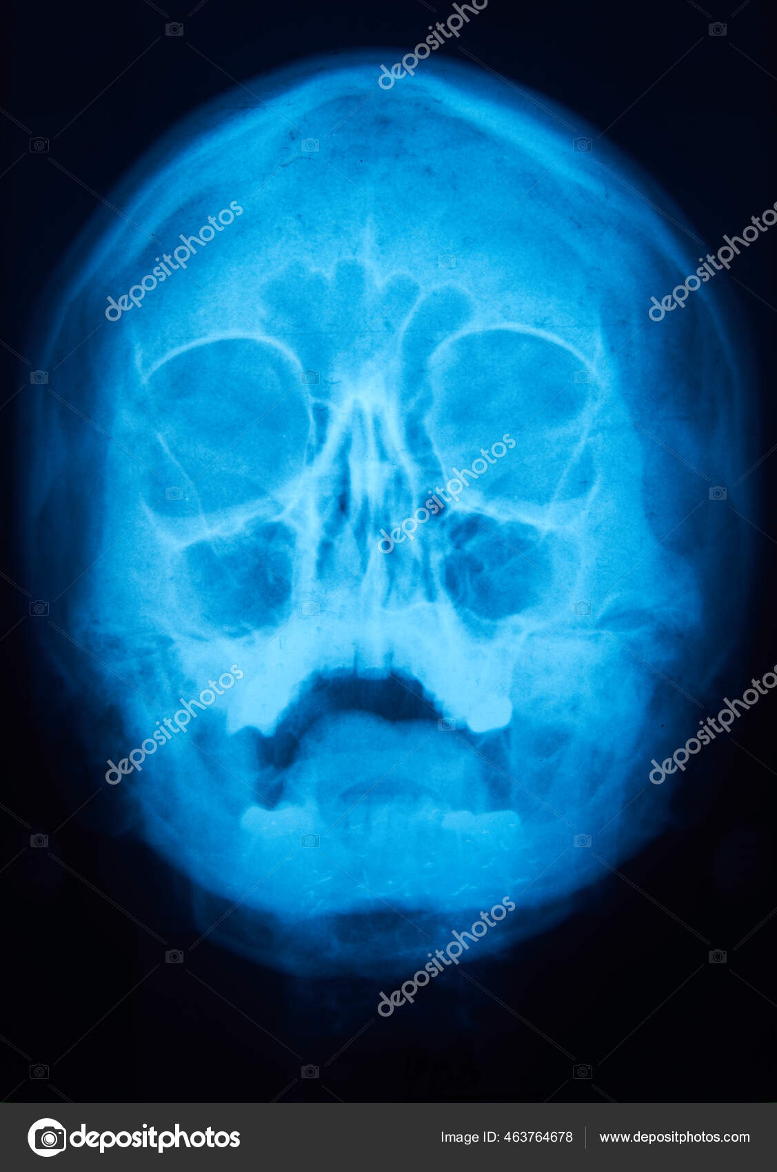 X Ray Head Front