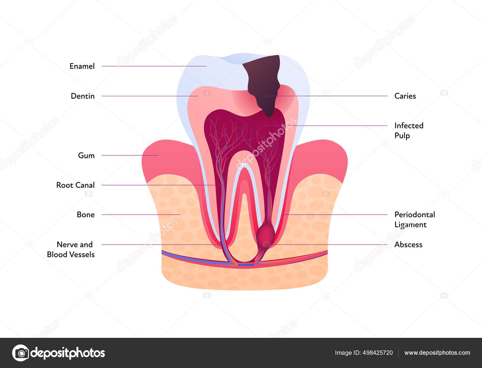 Image vectorielle Anatomie Tableau Carie Dentaire Illustration Biomédicale Vectorielle Coupe ...