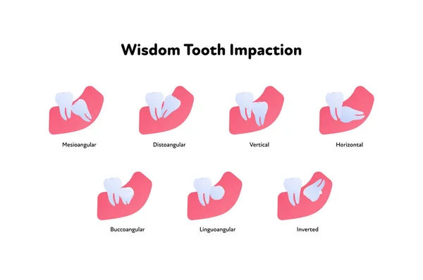 Wisdom teeth impaction Vector Art Stock Images | Depositphotos