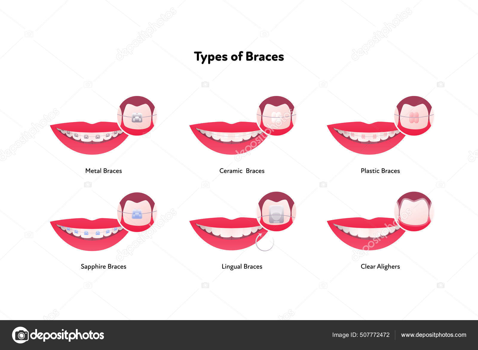 Dental Teeth Braces Types Infographic Vector Flat Healthcare ...