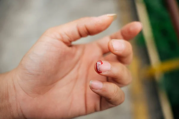 Lesion de deposrtista Stock Photos, Royalty Free Lesion de deposrtista ...