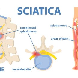 Sciatica Stock Photos, Royalty Free Sciatica Images | Depositphotos