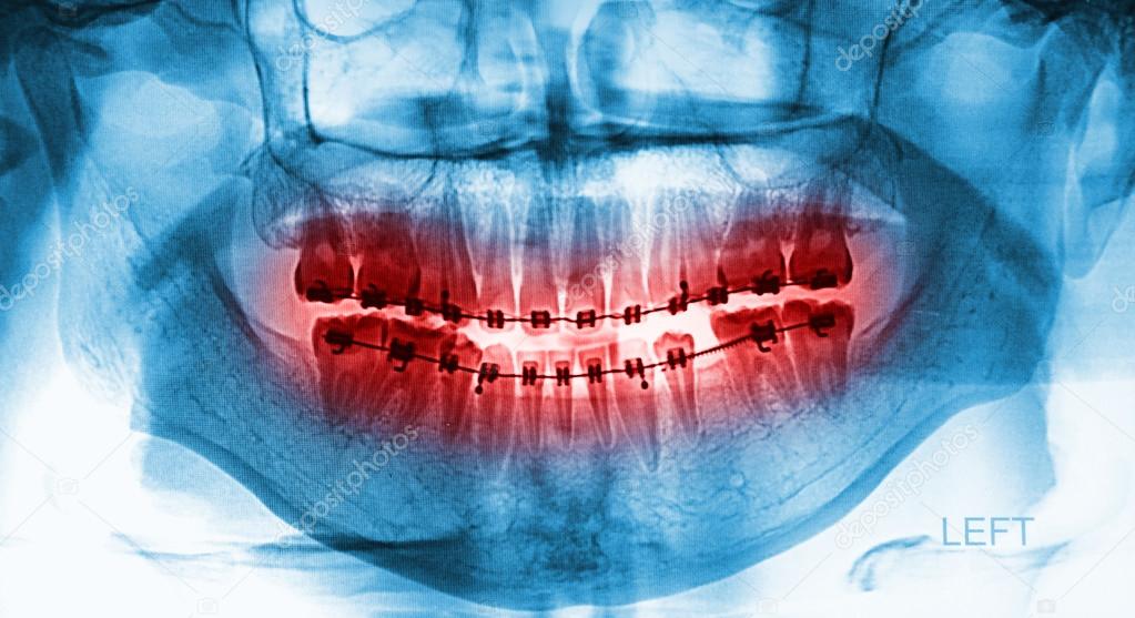 X-Ray scan human for teeth Stock Illustration by ©wittybear #52418091