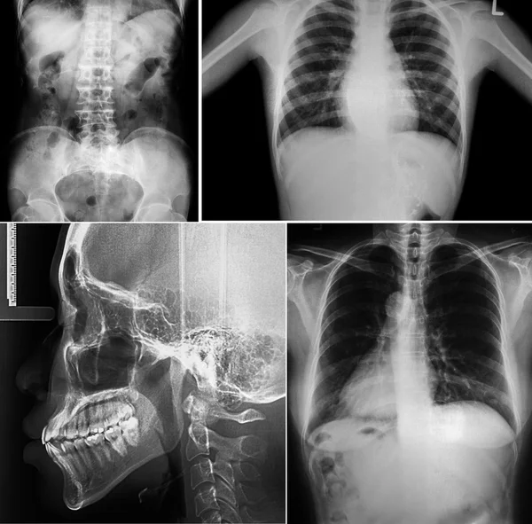 Collage of human X-rays photo Stock Photo by ©wittybear 54773347