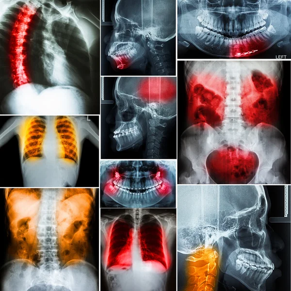 Collage of human X-rays photo — Stock Photo © wittybear #54773347