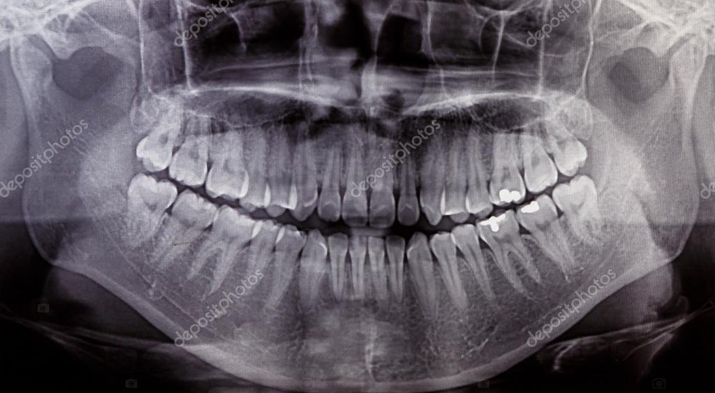 X-Ray scan of teeth — Stock Photo © wittybear #63260957