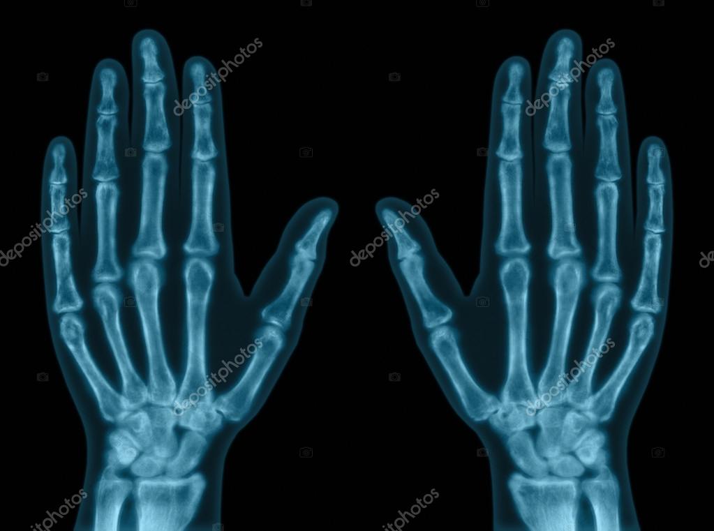 X-ray of both hands Stock Photo by ©ktsdesign 63187685