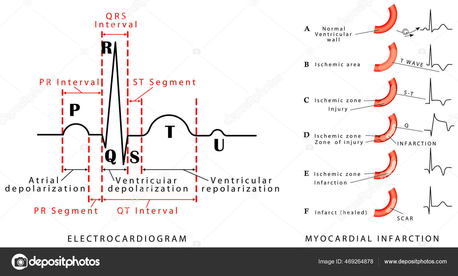 Ecg Normal Vs Ecg De Ataque Cardiaco