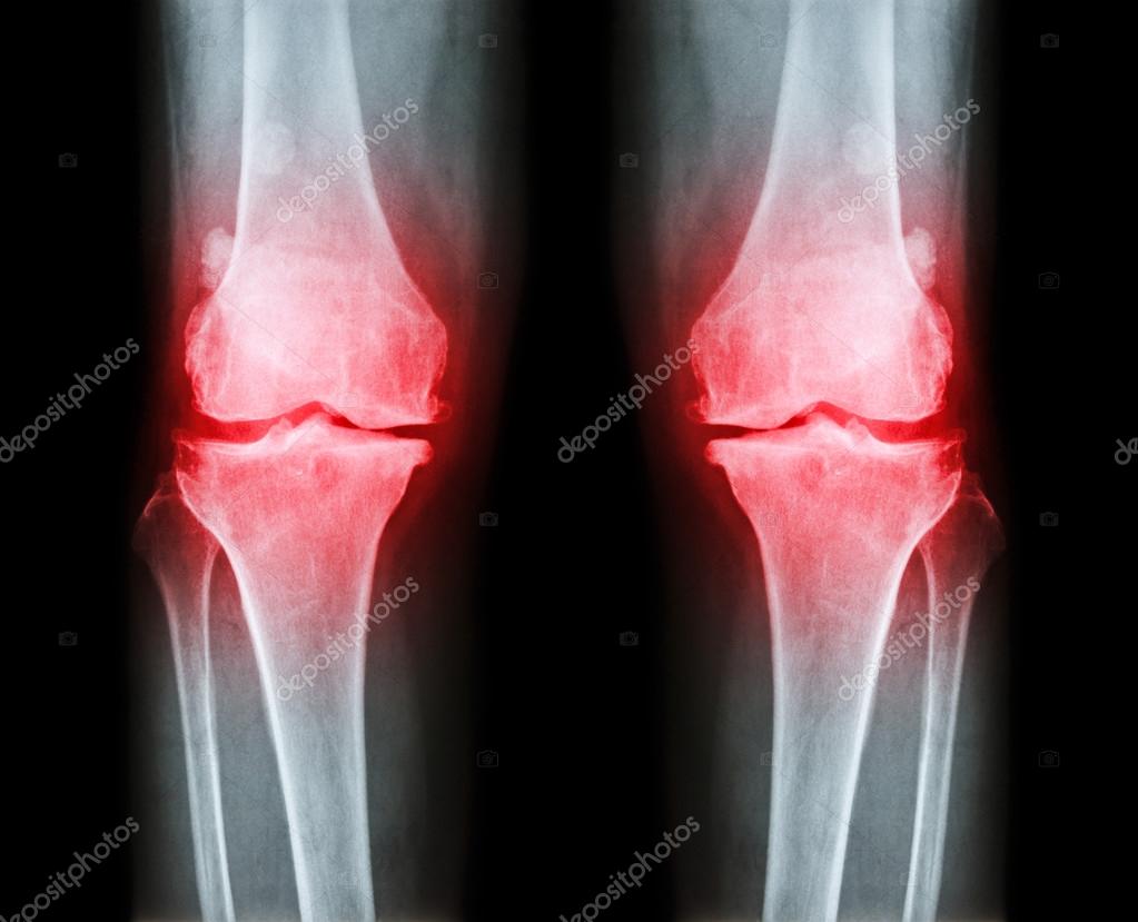 Osteoarthritis both knee . film x-ray AP ( anterior - posterior ) of ...