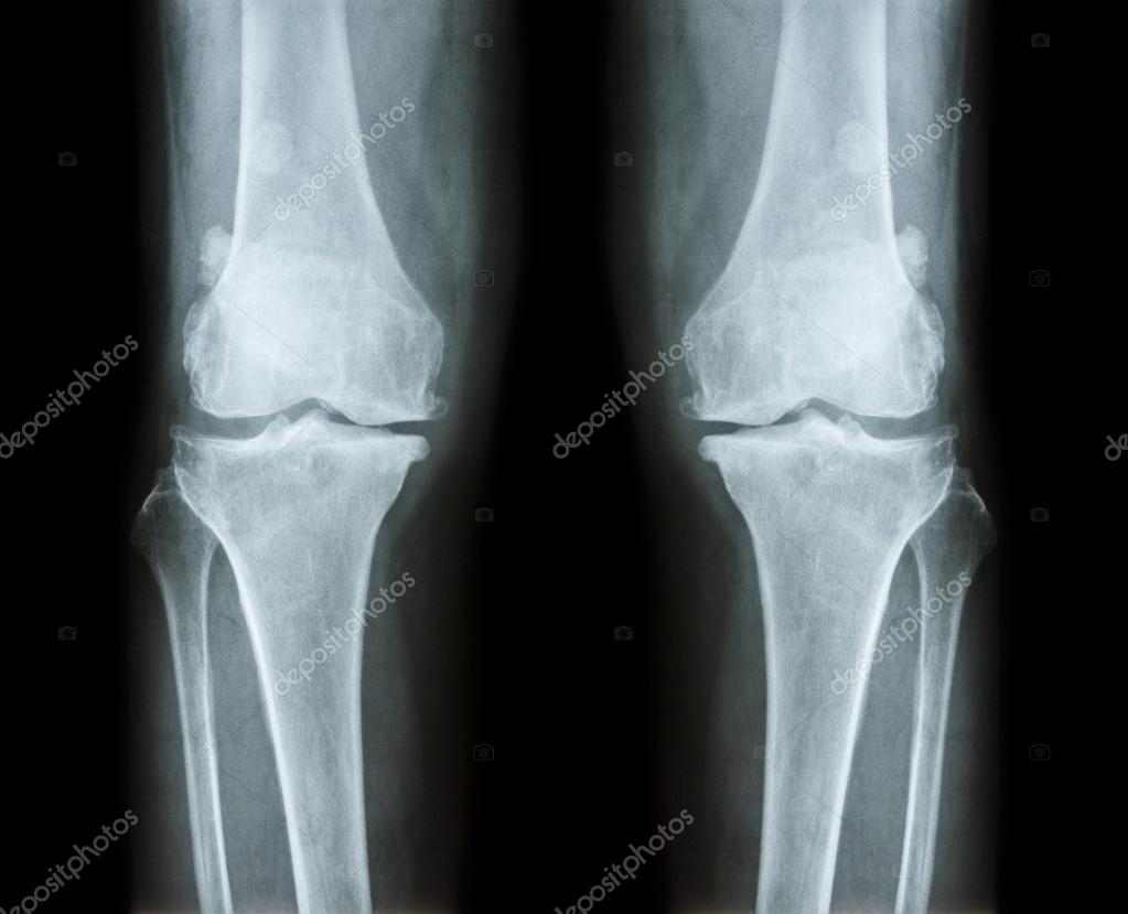 Osteoartritis ambas rodillas. la radiografía de la película AP ...