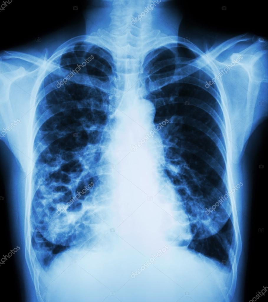 Bronchiectasis — Stock Photo © stockdevil_666 #61191893