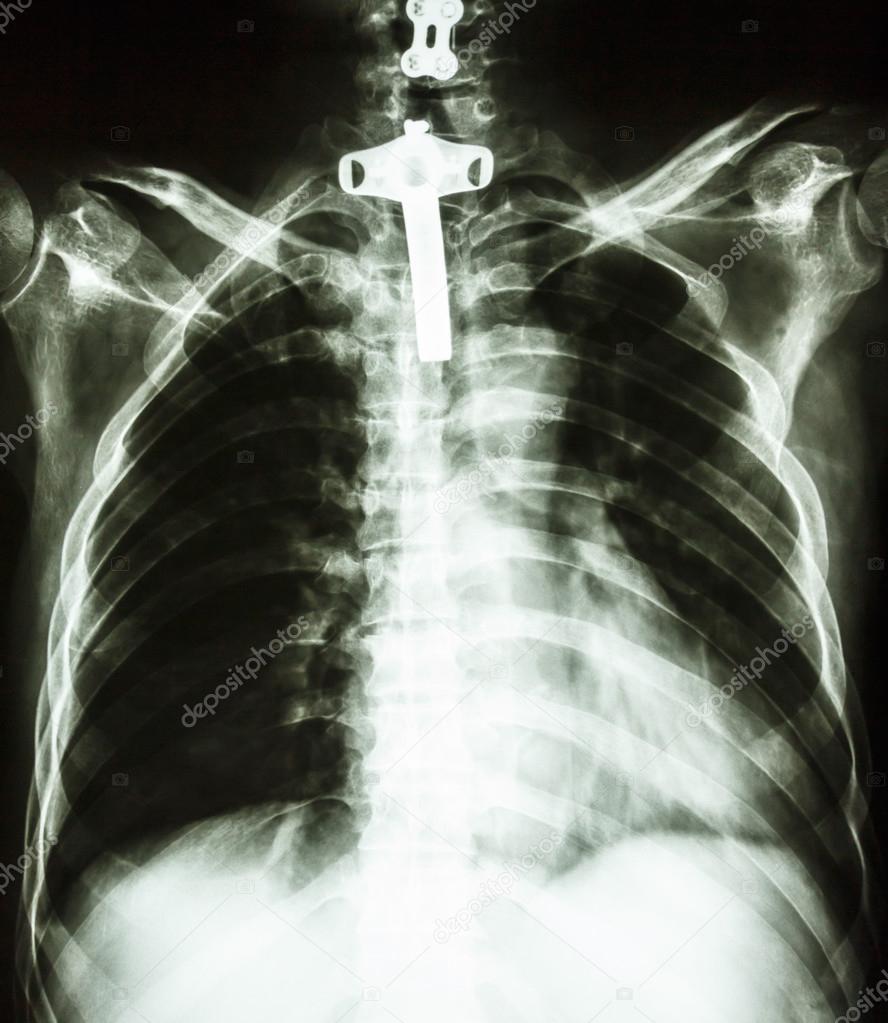 Human chest with tracheotomy tube Stock Photo by ©stockdevil_666 61192927