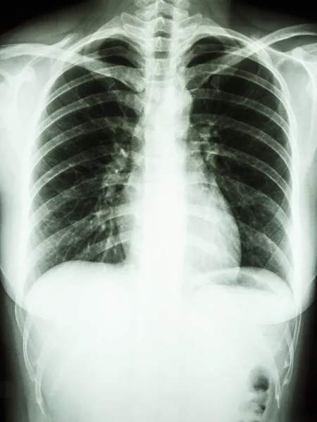 Radiograph of human chest Stock Photo by ©fotokon 63687929