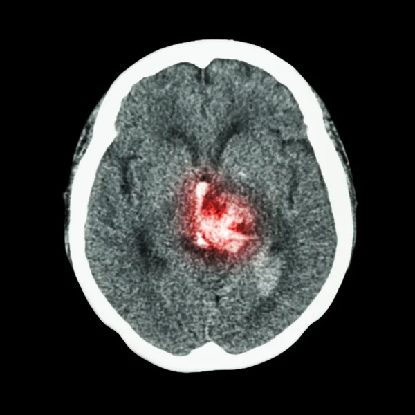 CT scan of brain with red area ( Imaging for hemorrhagic stroke or ...