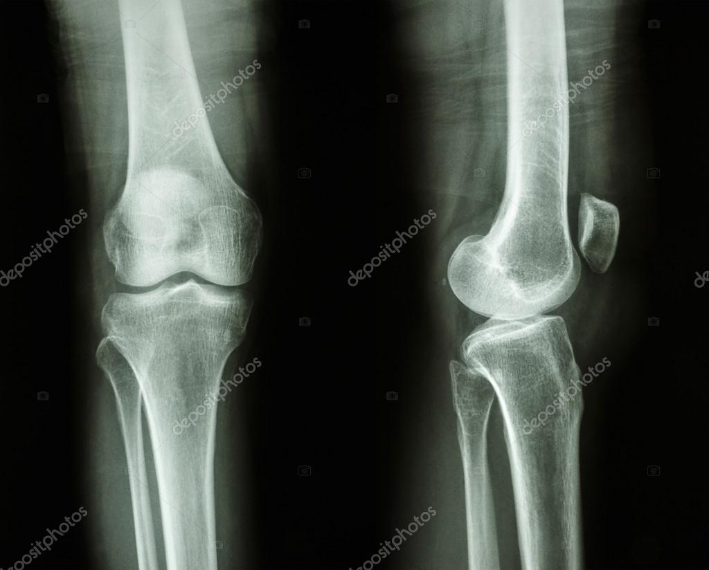 Rodilla humana normal: fotografía de stock © stockdevil_666 #61211855 ...