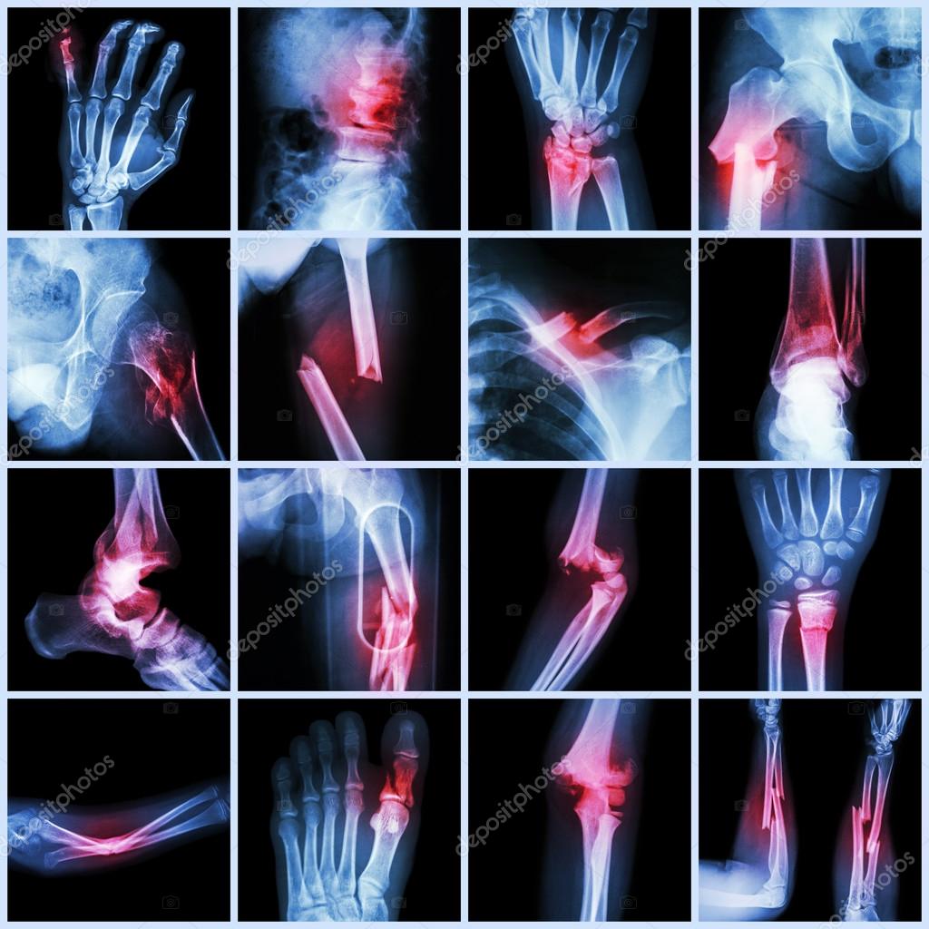 Collection X-ray multiple bone fracture (finger,spine,wrist,hip,leg ...