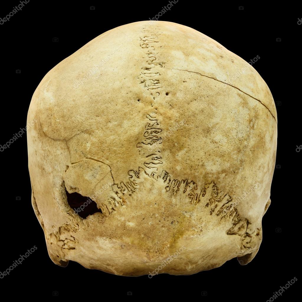 Fractura del cráneo humano (parte posterior) (mongoloide, asiático) en ...