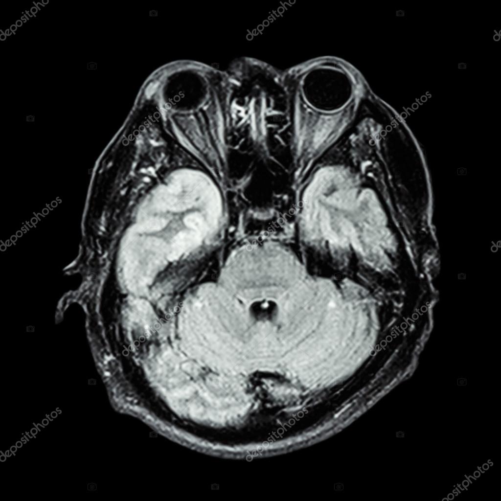 MRI brain : show lower part of brain(cerebellum,temporal lobe of ...