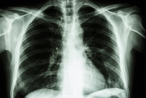 Radiograph of human chest Stock Photo by ©fotokon 63687929