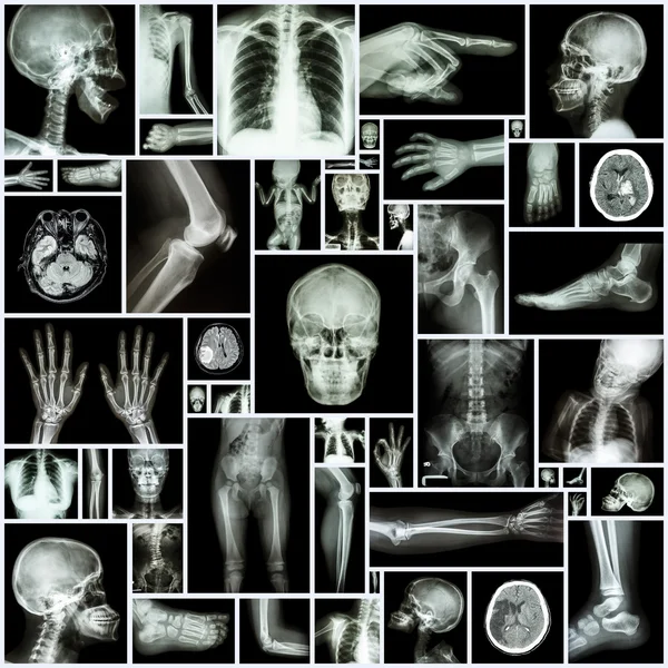Collection X-ray "Multiple part of human,orthopedic surgery and ...