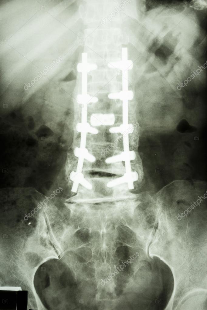 Lumbar spine with pedicle screw fixation — Stock Photo © stockdevil_666 ...